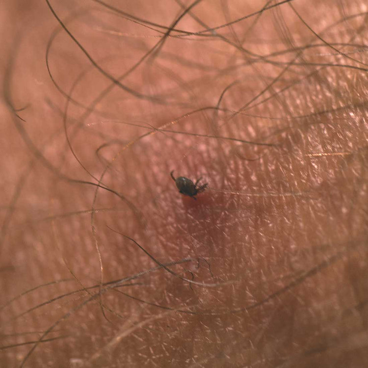 human ticks removal